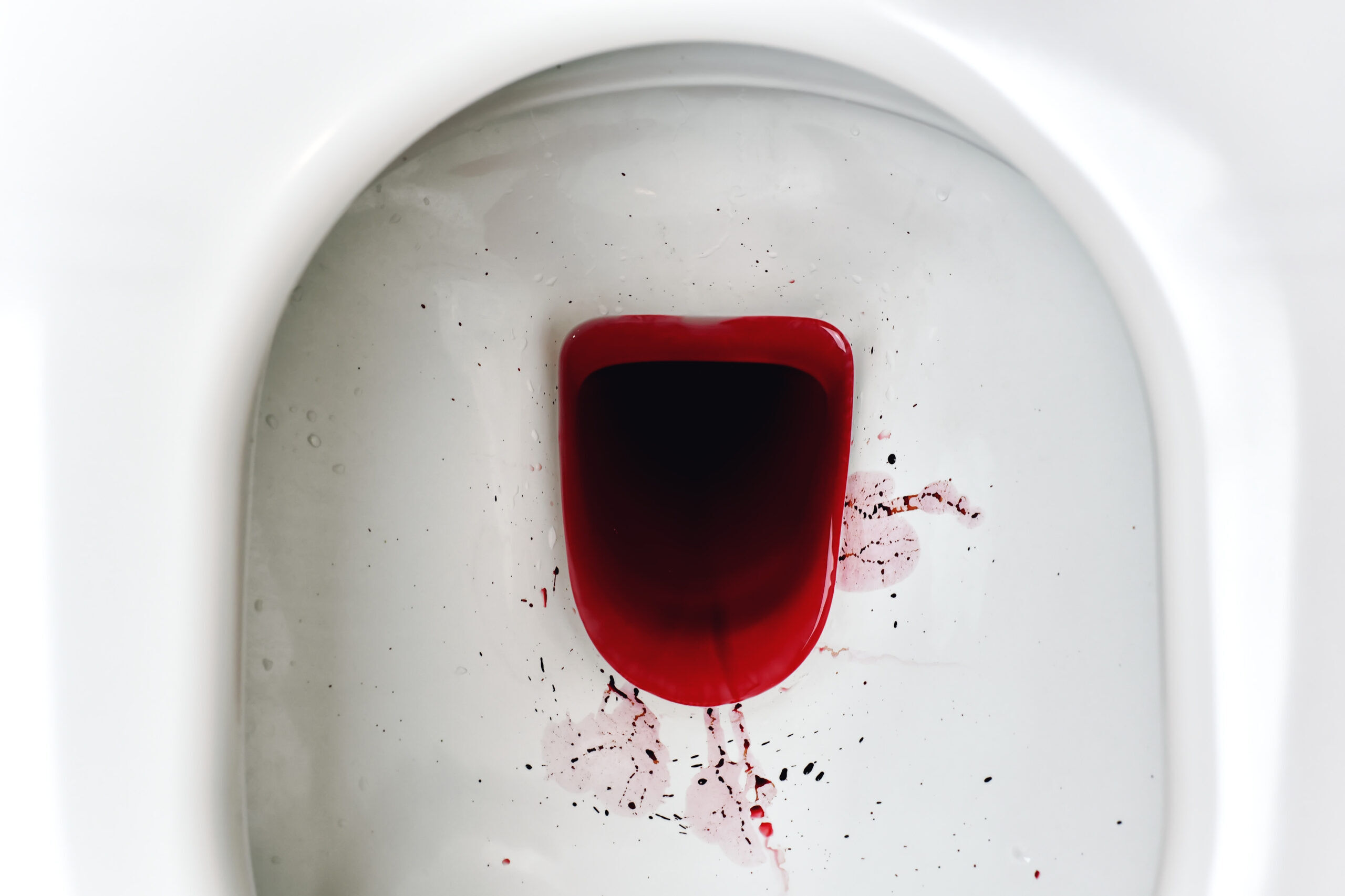 Bleeding from the rectum: What do you need to know? - The Surgeon