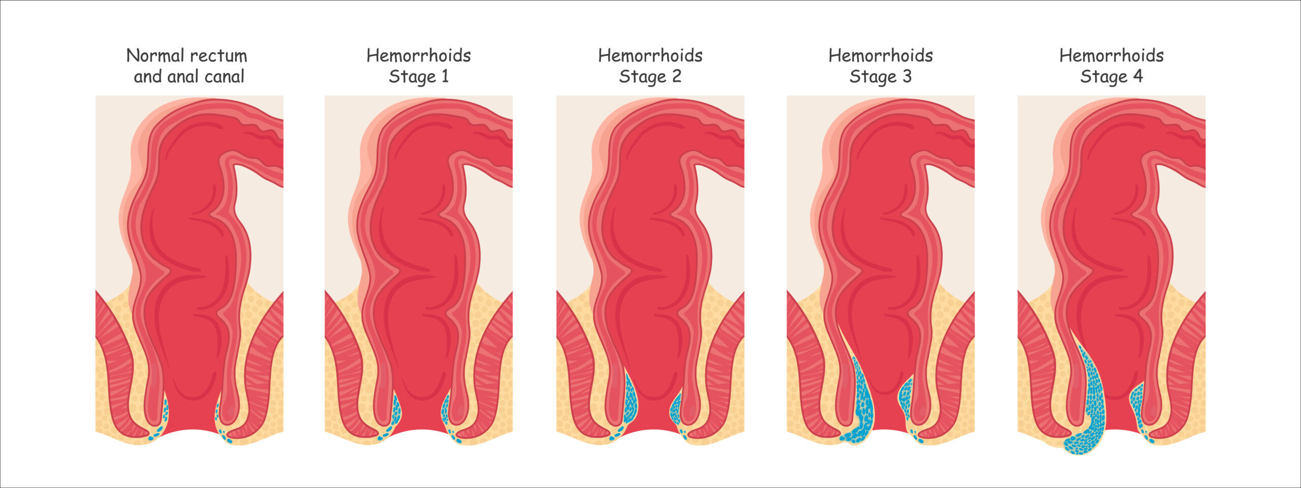 Surgical treatment of hemorrhoids with Milligan-Morgan - The Surgeon